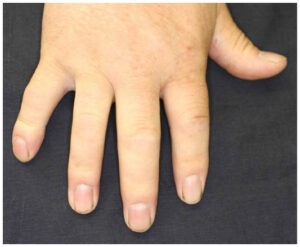 What Causes Swollen Bruised Finger No Reason & How Do I Fix This