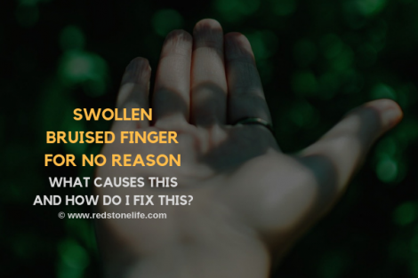 What Causes Swollen Bruised Finger No Reason & How Do I Fix This